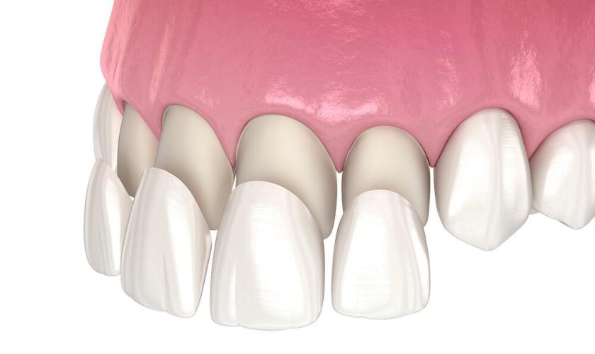 How Dental Veneers Can Transform Your Smile in 2024 | Young Dental Care